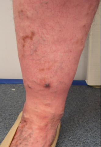 Understanding Varicose Vein Ruptures and Bleeding: Causes, Risks, and ...