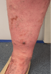 Understanding Varicose Vein Ruptures and Bleeding: Causes, Risks, and ...