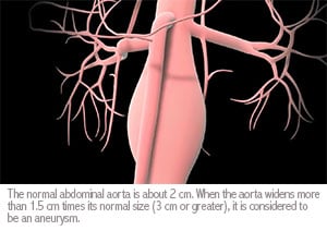 Surgical Considerations for Aortic Aneurysms