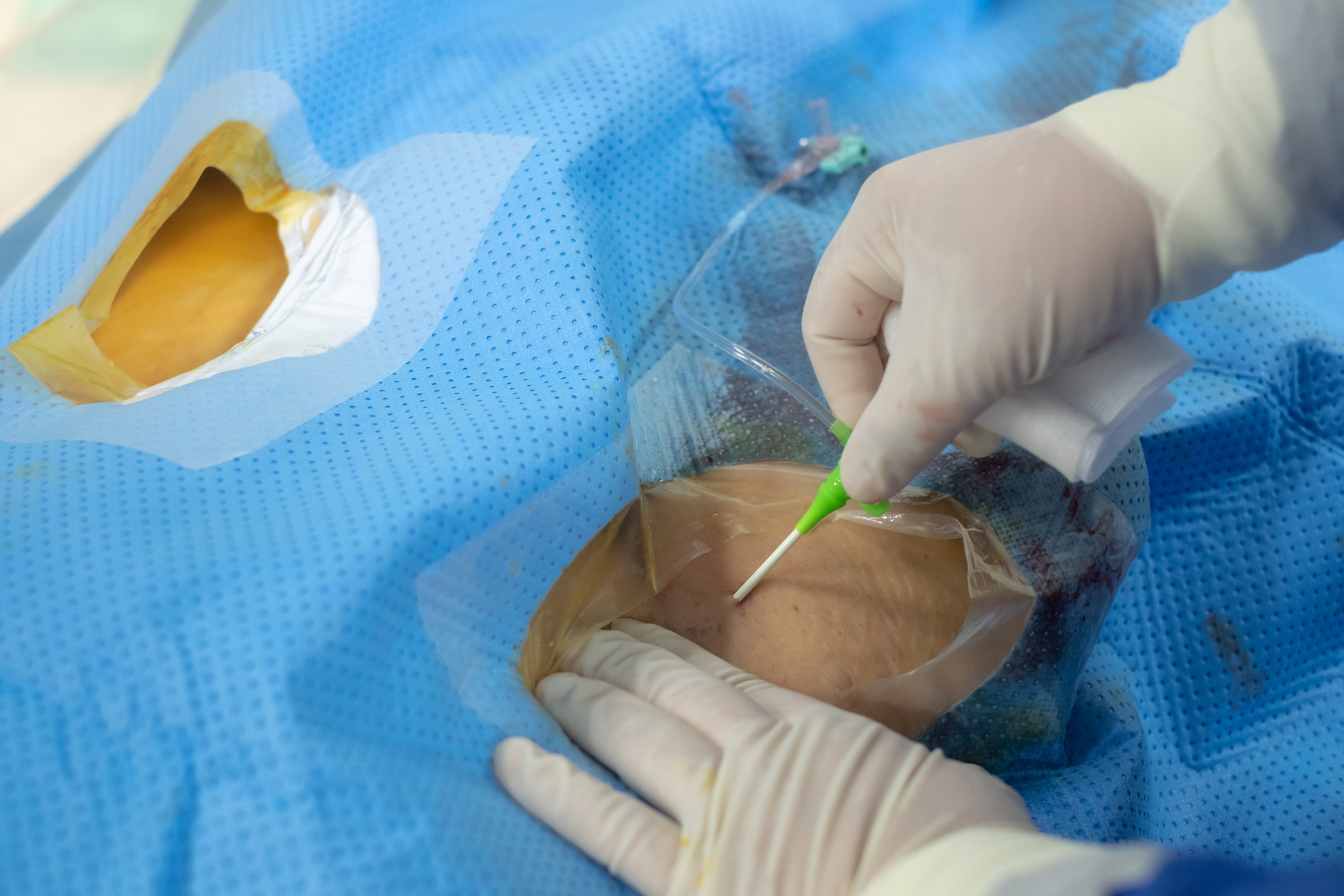 What Is An Angiogram Of The Leg What Is An Angiogram Of The Leg